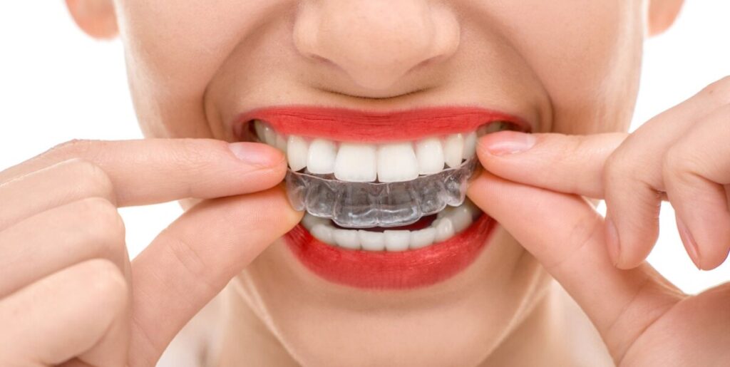 Brackets o invisalign: ¿cuáles son sus diferencias? - WikiDiferencias.com